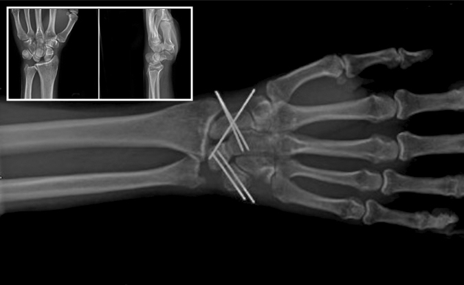 DISLOCATION, WRIST PERILUNATE | Hand Surgery Resource
